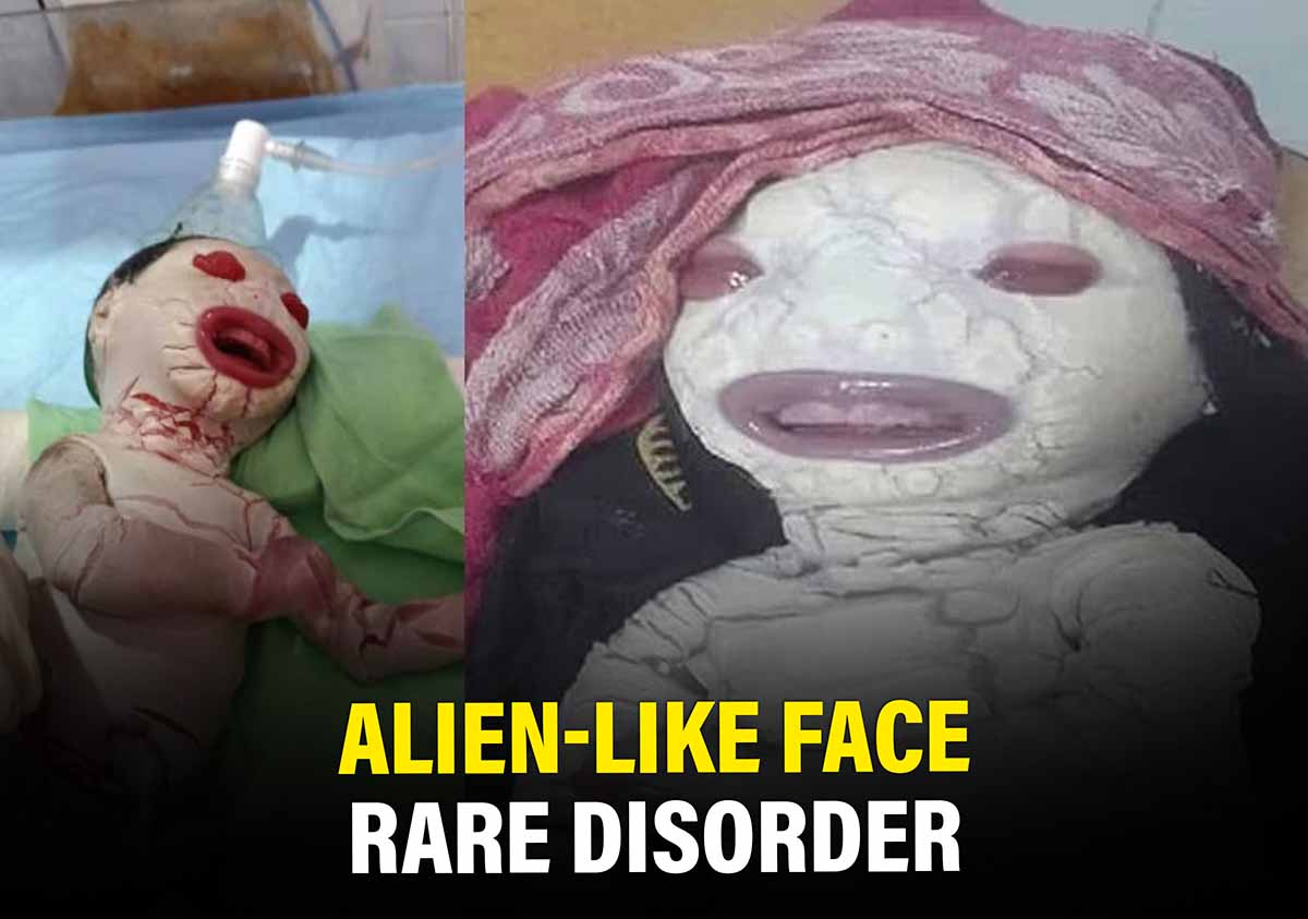 Newborn With Alien-Like Face Born in Rewa, Doctors Identify Rare Skin ...